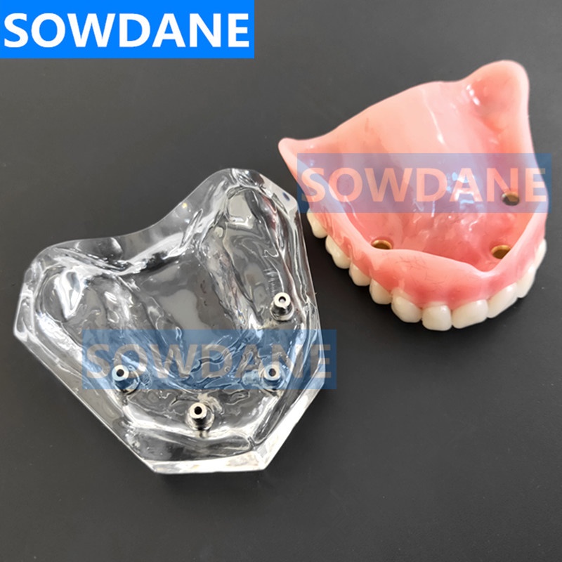 Jual Dental Overdenture Upper Anterior Maxillary with 4 Implant ...