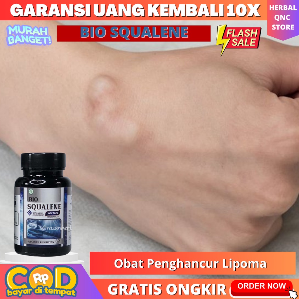 Jual Obat Penghancur Lipoma, Benjolan, Tiroid, Gondok, Bisul, Keratosis ...