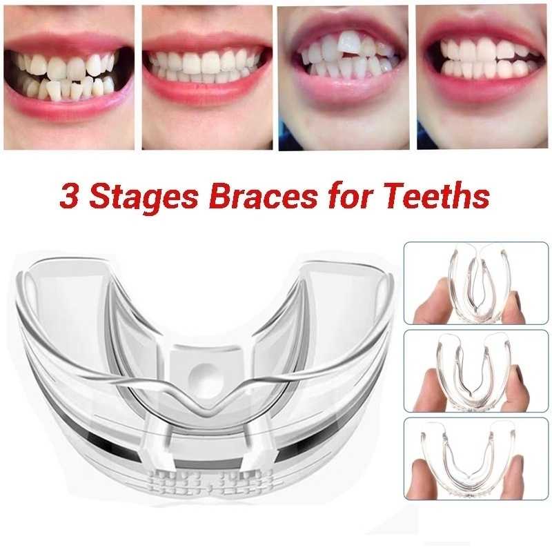 Jual Alat Perapi Gigi Dewasa Clear Aligner Teeth Braces Stage 3 Perapih ...