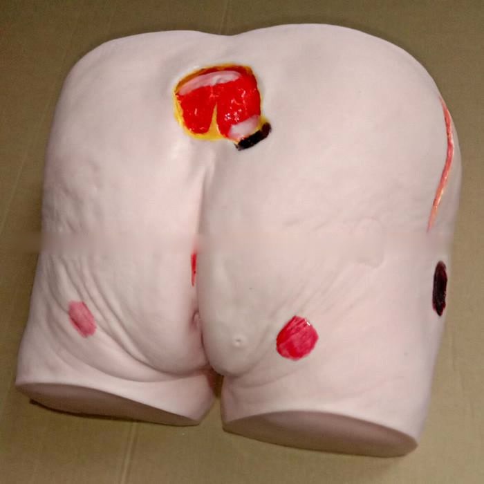 Jual Ulkus Dekubitus | Phantom Manikin Dekubitus | Model Luka Decubitus ...
