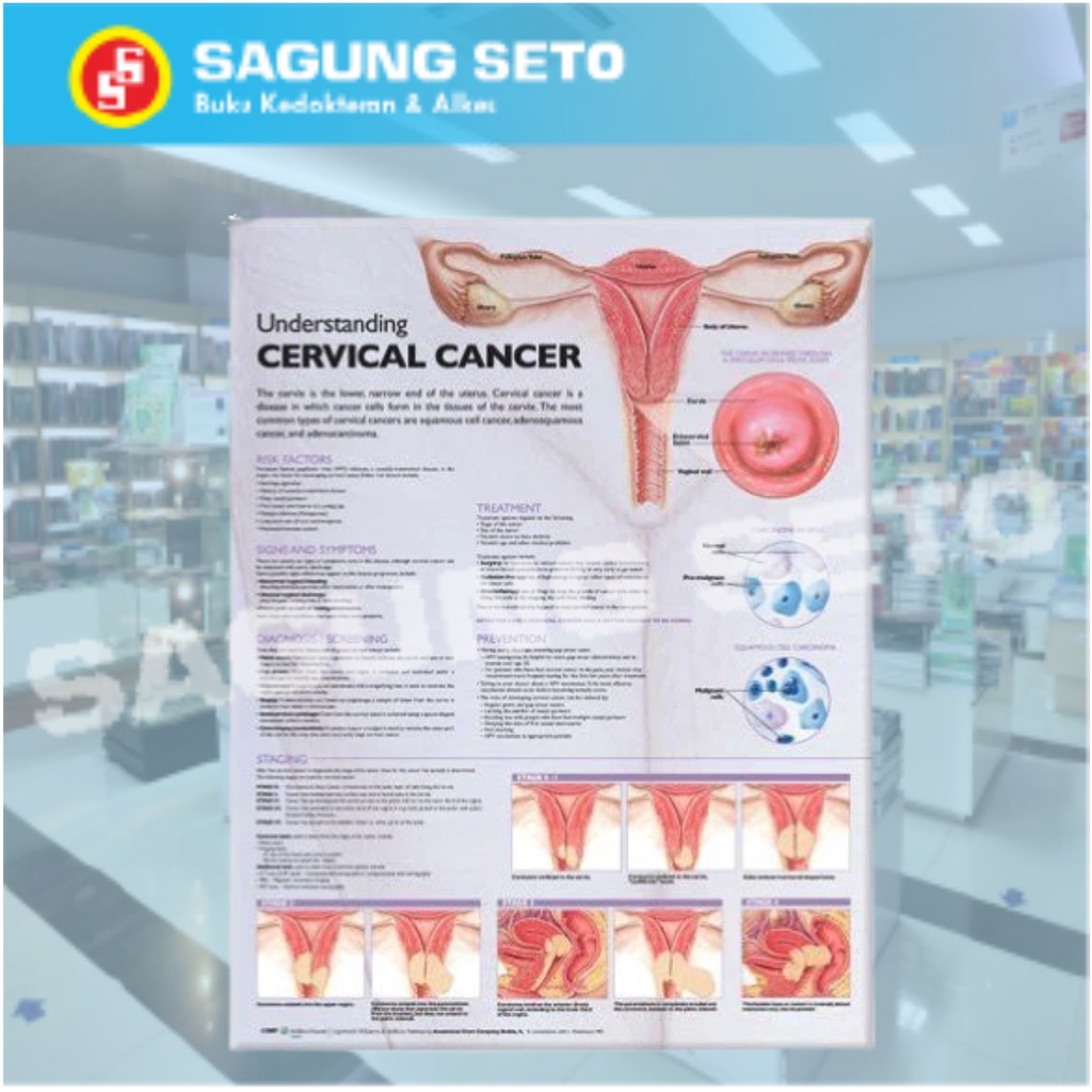 Jual POSTER UNDERSTANDING CERVICAL CANCER LAMINATED ( 2D ) | Shopee ...