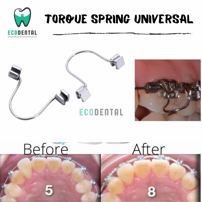 Jual Dental Torque Spring Universal Labial Lingual Root Torquing Ortho ...