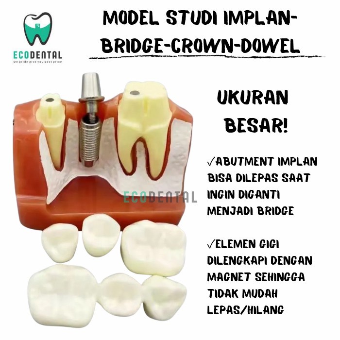 Jual Dental Model Studi Implan Bridge Gigi Tiruan Jembatan Dowel Jumbo ...