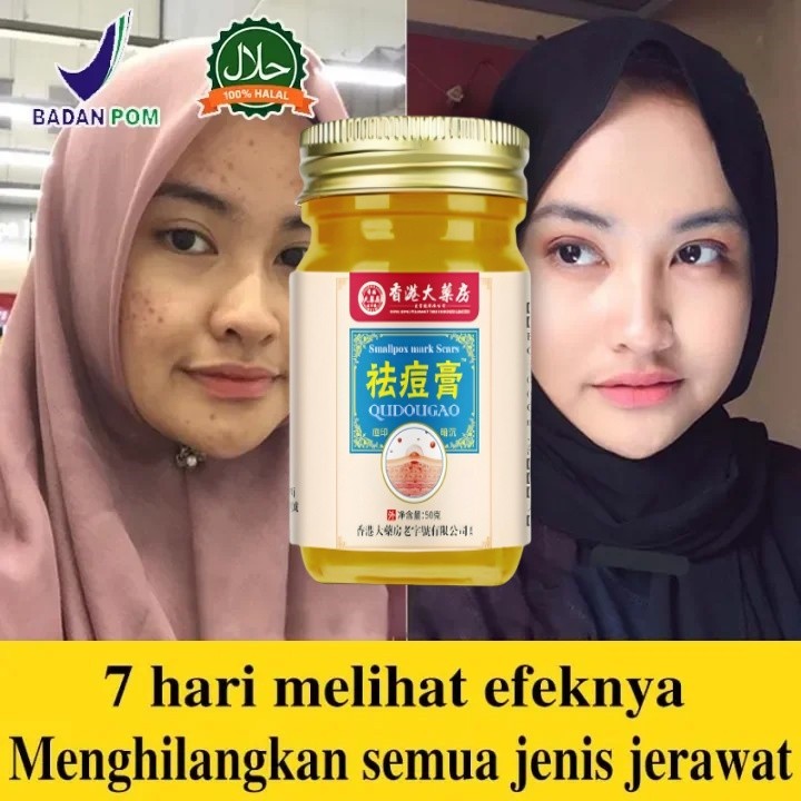 Jual Hong Kong Pharmacy Acne Treatment Cream Acne Removal Gel Acne ...