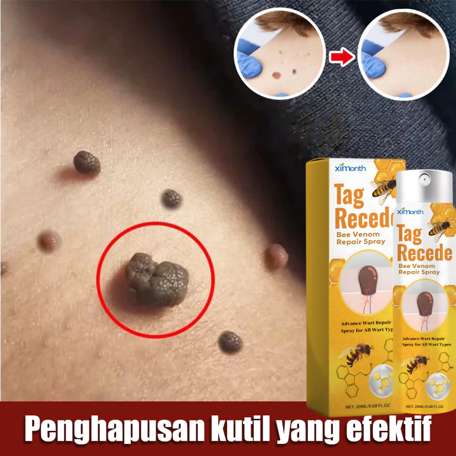 Jual Bee venom treatment spray Penghilang tahi lalat di wajah ...