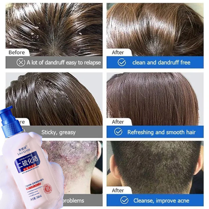 Jual Selenium Disulfide Shampoo 300MLOil Control Anti-Dandruff Anti-Itch Clear Malassezia ...