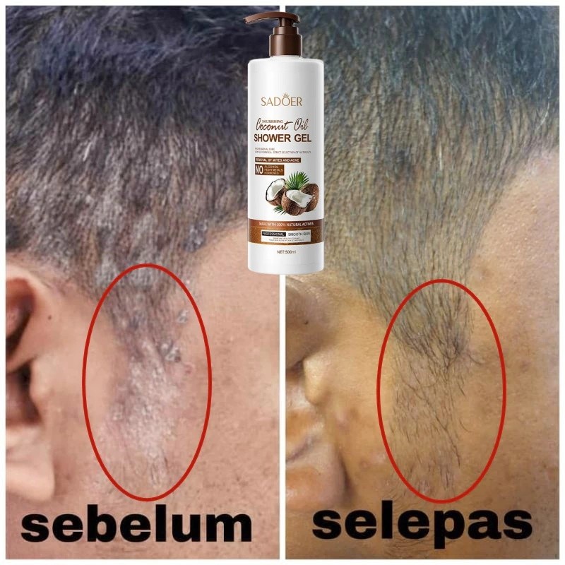 Jual SADOER Ekstrak Kelapa Oil control Shampo anti ketombe Penghilang Ketombe Berkerak Dan Gatal ...