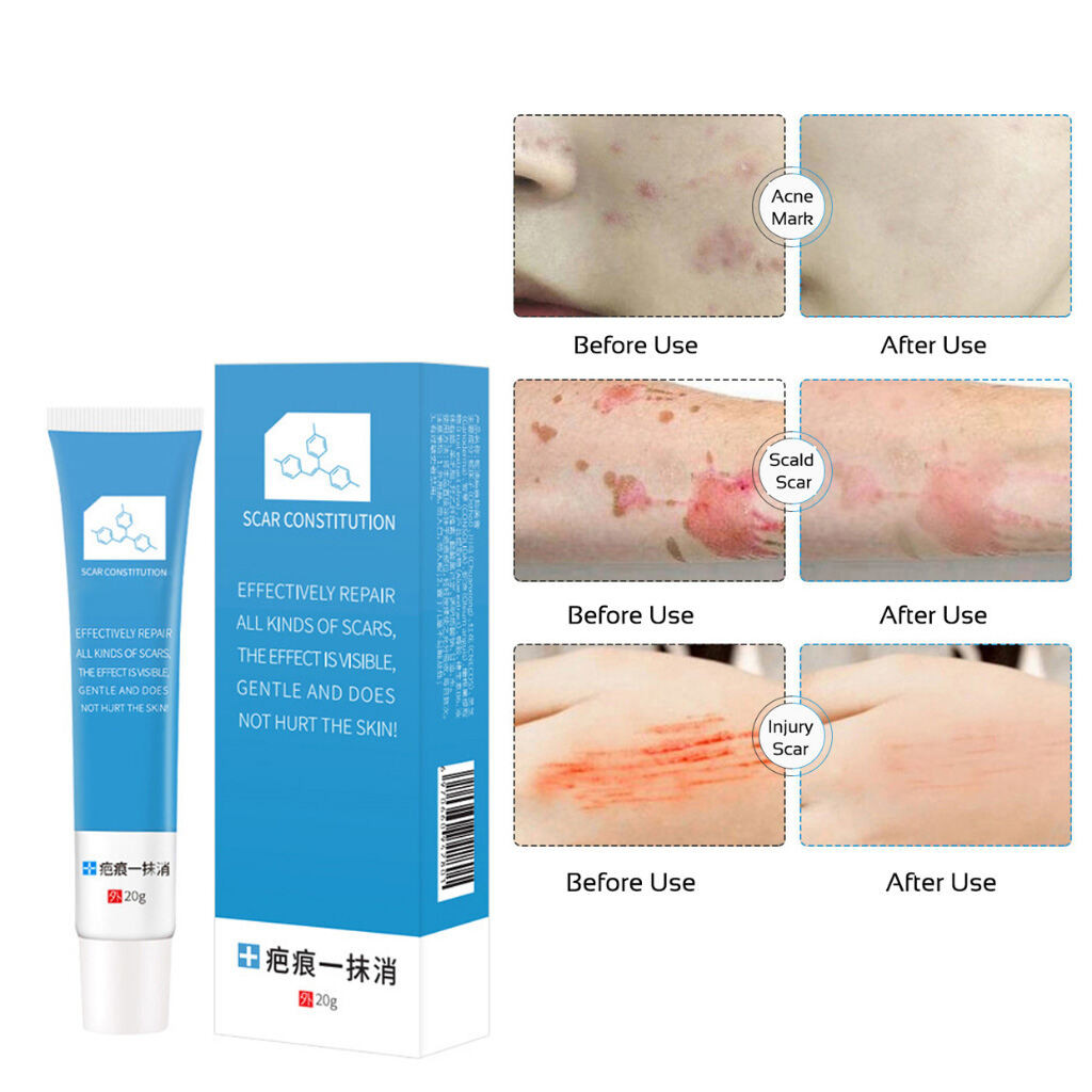 Jual 50%OFF 20g Scar Cream Scar Removal Cream Peklat Remover Acne ...