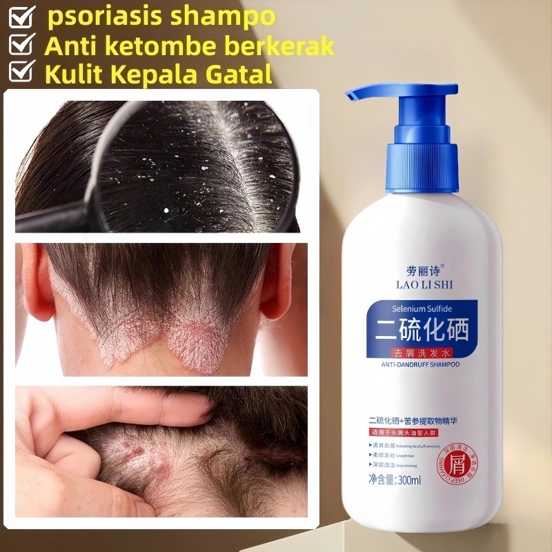 Jual Selenium Disulfide Shampoo 300MLOil Control Anti-Dandruff Anti-Itch Clear Malassezia ...