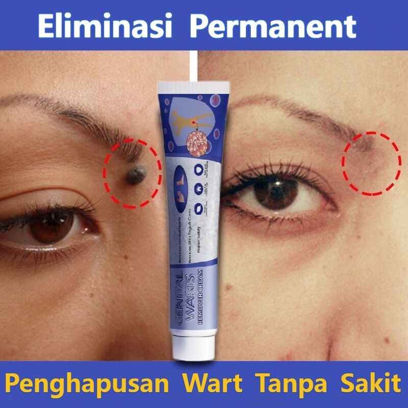 Jual 100% originalWarts Remover Cream painless 20g Mole And Warts ...