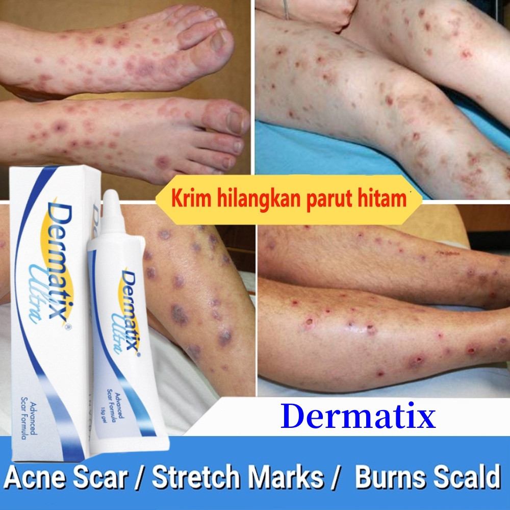 Jual Dermatix Salep penghilang bekas luka Penghilang bekas luka hitam ...