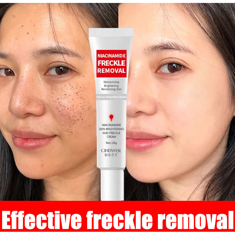 Jual CINDYNAL SKIN CREAM FRECKLE REMOVAL Krim Pemutih Penghilang Bintik Wajah BPOM 20g | Shopee ...