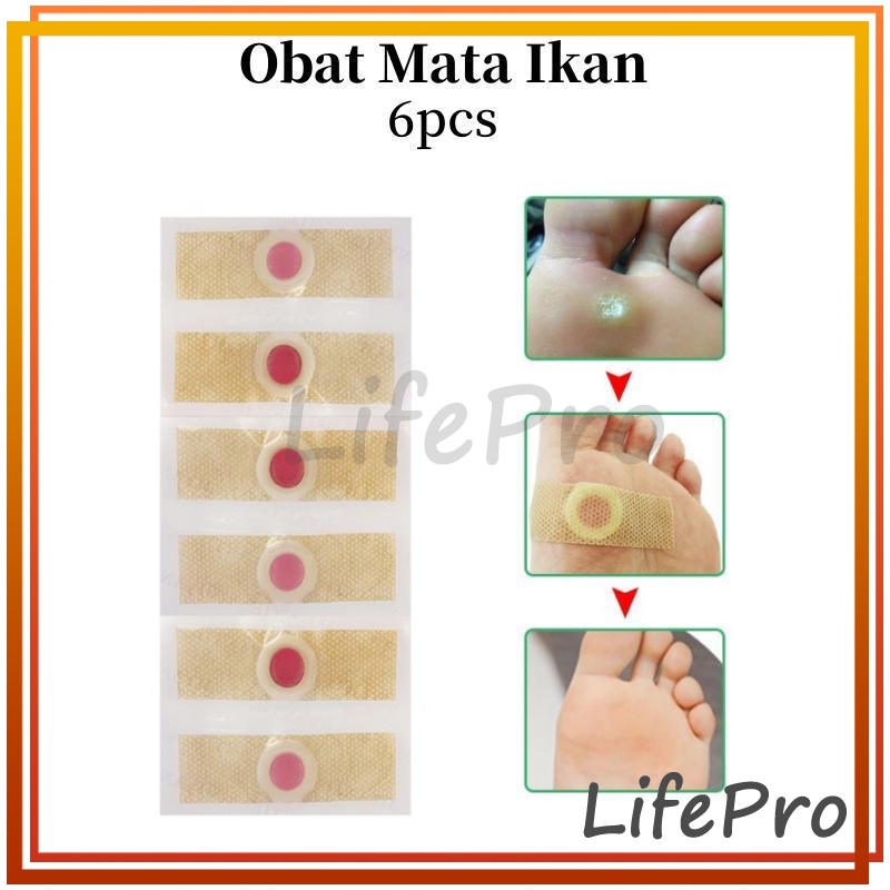 Jual Plester Mata Ikan dan Kutil 6 Pcs / 1 Strip Obat Mata Ikan ...
