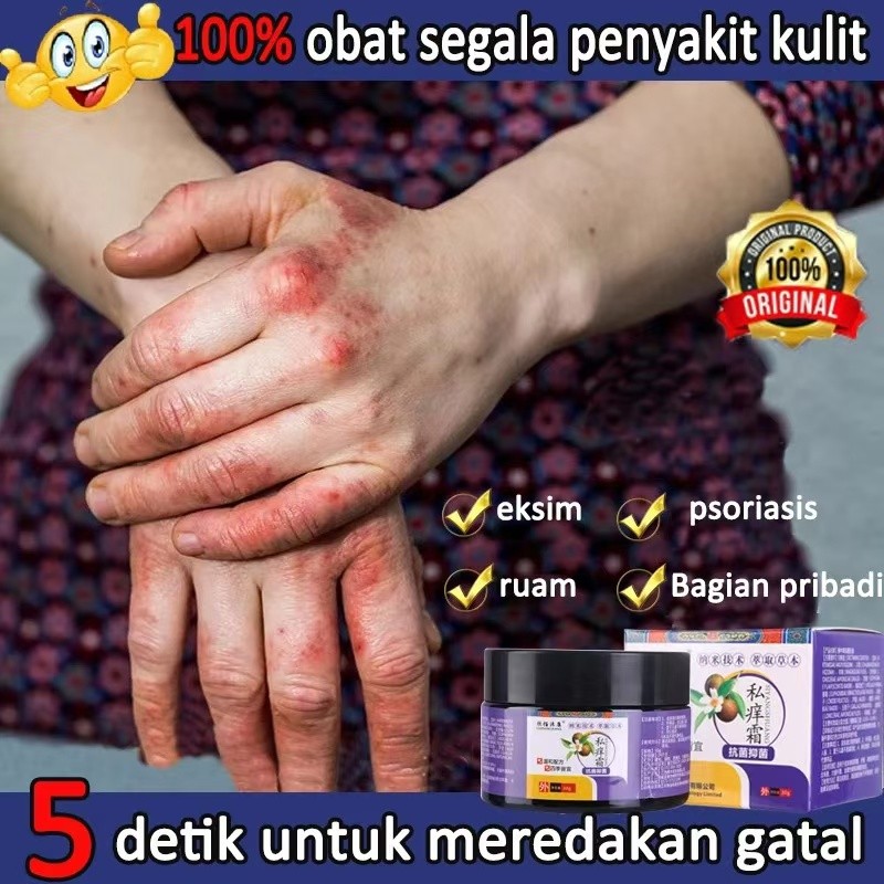 Jual 【100% Original】Salep Gatal Paling Ampuh Obat Psoriasis Salep Gatal ...