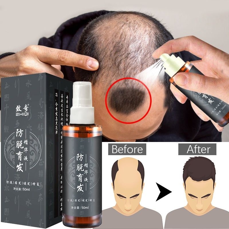 Jual COD Serum Penumbuh Rambut Botak Serum Rambut Rontok Untuk Pria ...