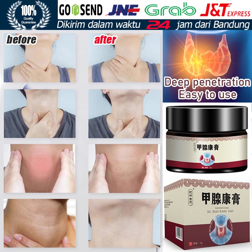 Jual Obat Gondok Kelenjar Tiroid / Hipertiroid Gondok / Beracun Kista ...