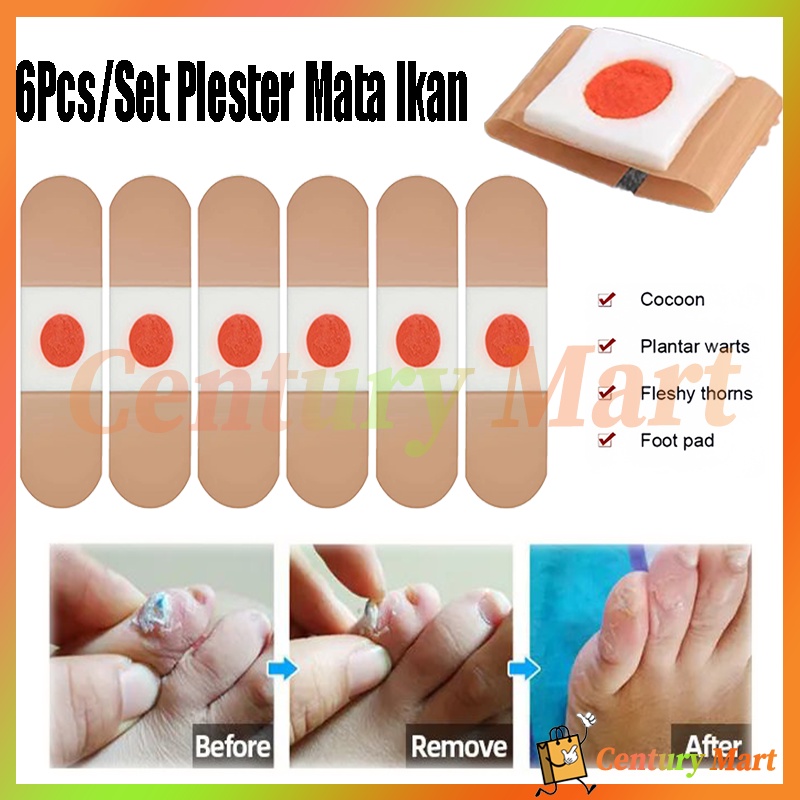 Jual 【Harga grosir】Plester Obat Kutil & Mata Ikan ( 1 BOX 6pcs ...