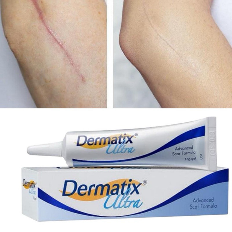 Jual Dermatix Ultra Gel 15g / Penghilang Bekas Luka / Keloid ...