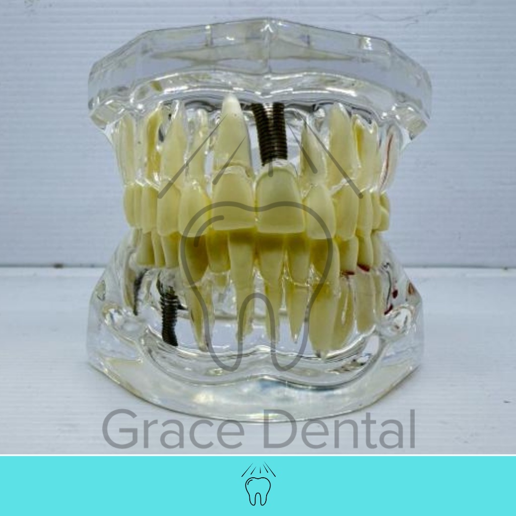 Jual Model Gigi Penyakit Lengkap Karies Endo Exo Bridge Implant ...