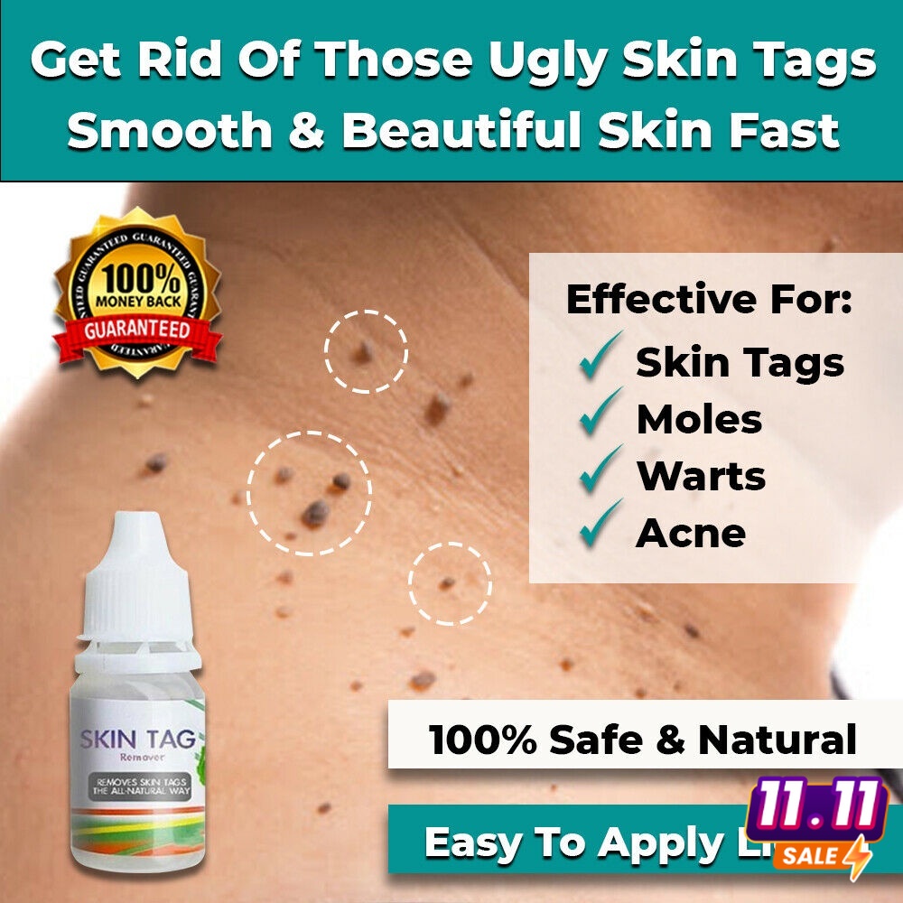 Jual ORIGINAL Wart Remover | Skin Tags & Moles Remover | Obat ...