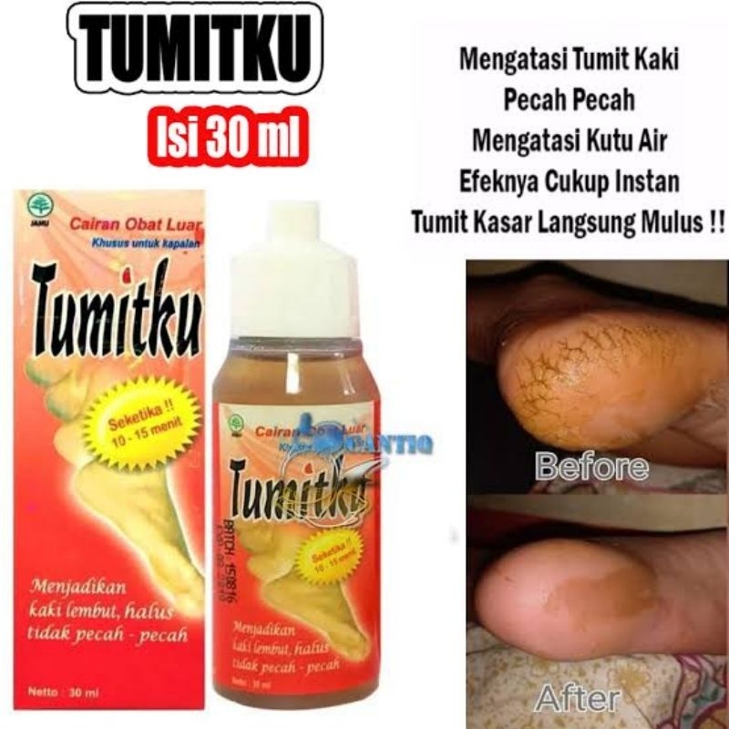 Jual LIVE! Tumitku 30 Ml - obat oles kaki kaki kaki pecah-pecah kapalan ...