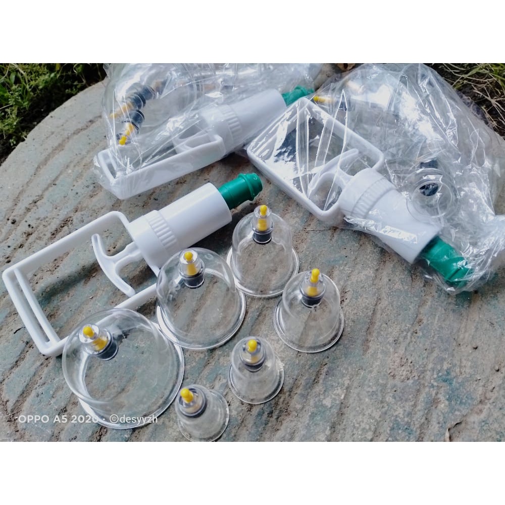 Jual ALAT BEKAM KOP ANGIN 6 PCS (PULL OUT AVACUUM APPARATUS) | Shopee Indonesia
