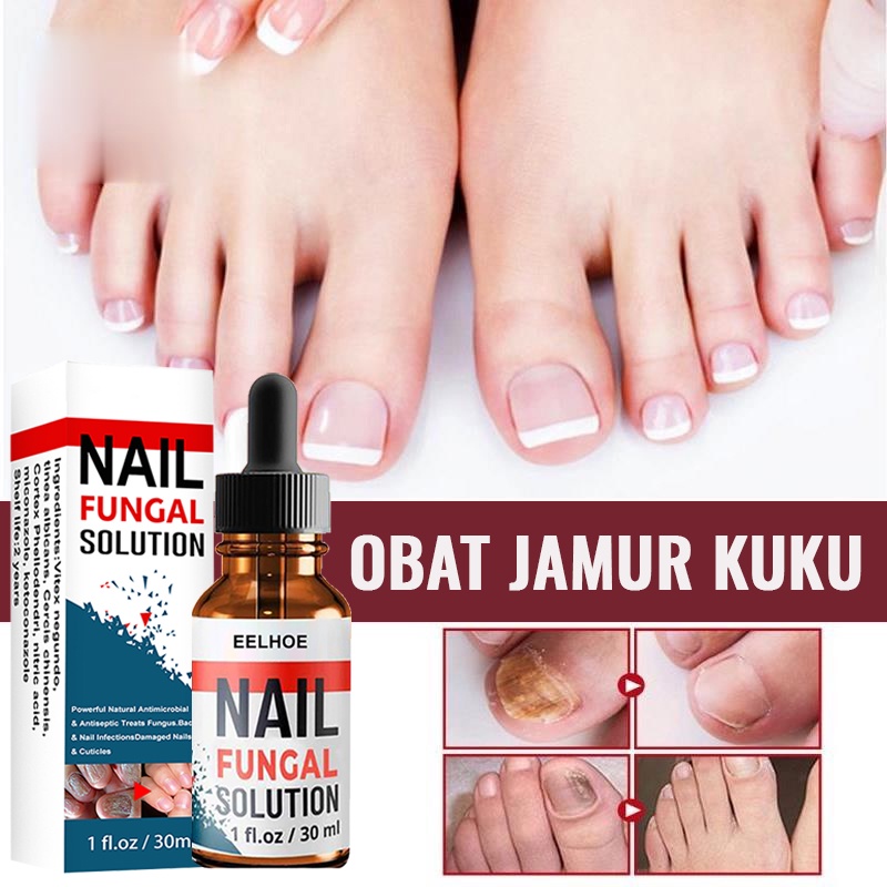 Jual EELHOE Obat Jamur Kuku Paling Ampuh Serum Kuku Jamur Dan Rusak ...