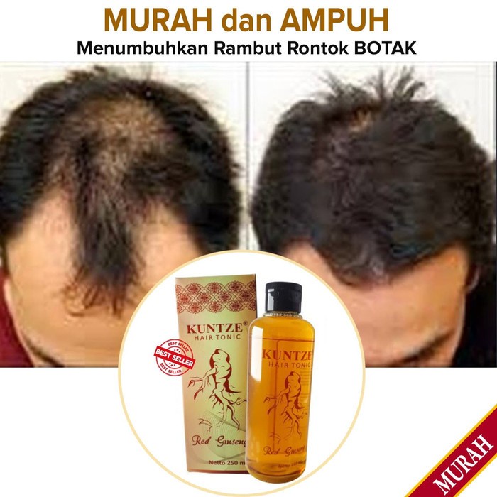 Jual Penumbuh Rambut Pelebat Rambut Penyubur Rambut Obat Rambut Botak ...