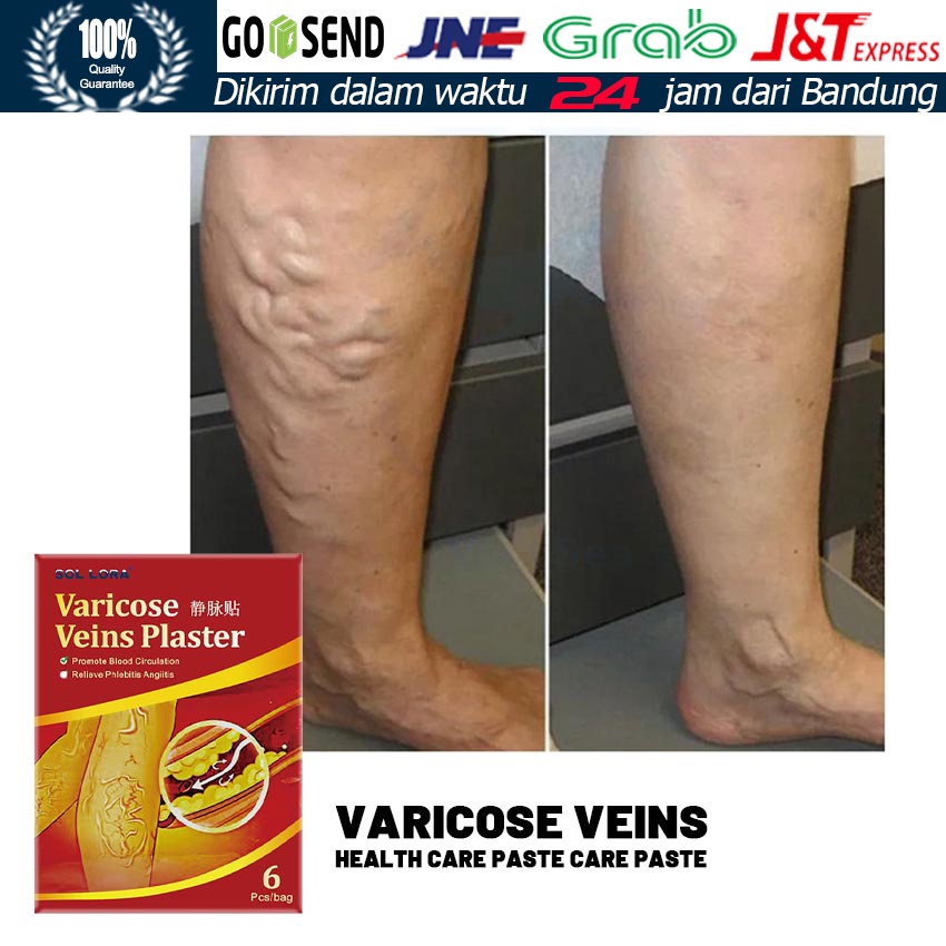 Jual 6Pcs/Set Koyo Obat Penghilang Varises / Varicose Veins Patch ...