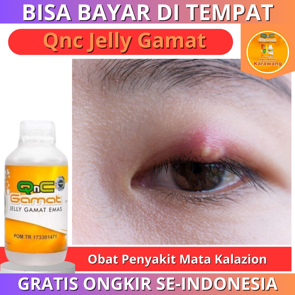Jual Obat Penyakit Mata Kalazion, Benjolan Di Kelopak Mata, Obat Sakit ...