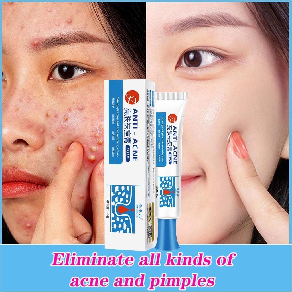 Jual Acne Cream Obat jerawat dan bekas jerawat penghilang bekas jerawat ...