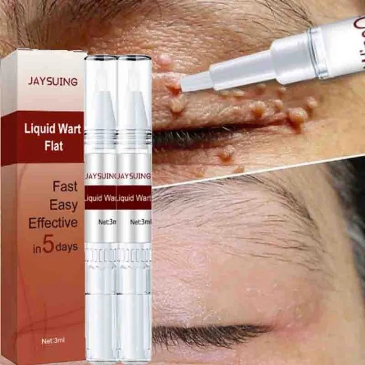 Jual Penghilang Kutil Dan Tahi Lalat Penghilang Kutil Di Wajah ...