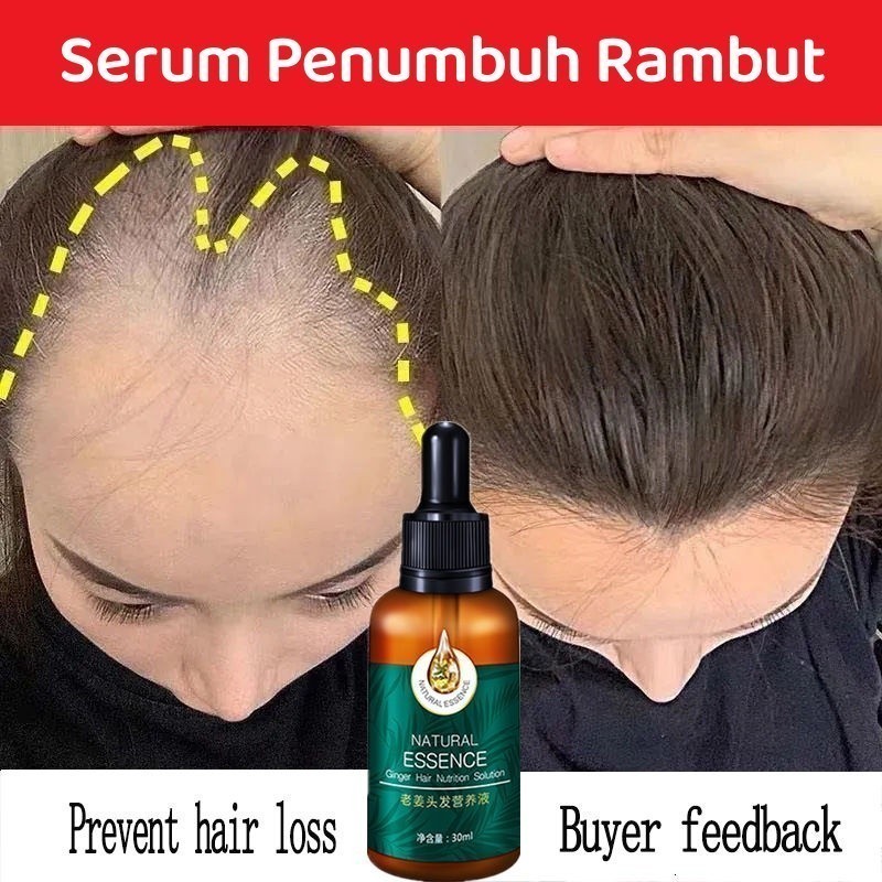 Jual 【HANYA 7 HARI】Serum Penumbuh Rambut Hair Tonic Penumbuh Rambut ...