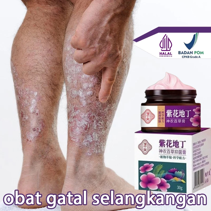 Jual Salep gatal salep china gatal paling ampuh obat gatal obat eksim ...