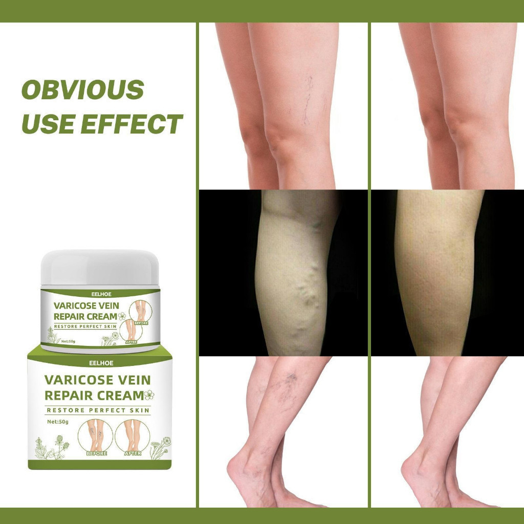 Jual EELHOE Varicose Veins Obat Varises Krim Salep China Untuk ...