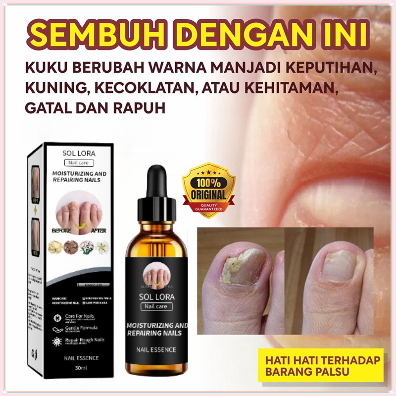 Jual SOLLORA（EELHOE ）Nail essence Solusi perbaikan kuku kelabu Obat ...