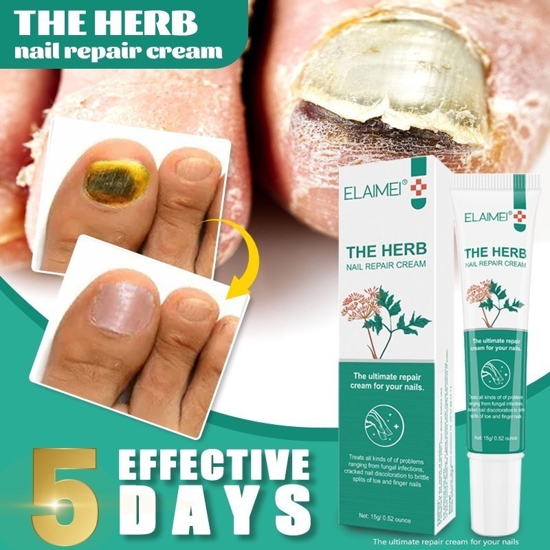 Jual ⭐️COD ORI⭐️ Obat Kuku Rusak Obat Jamur Kuku Obat Infeksi Kuku Anti ...