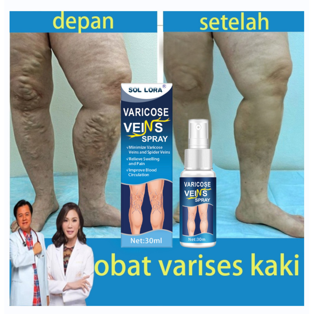 Jual Varicose Veins obat varises di kaki dan betis paling ampuh salep ...