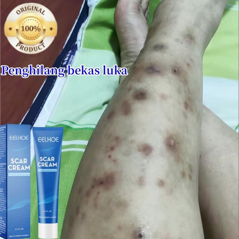 Jual Salep penghilang bekas luka Penghilang bekas luka hitam koreng ...