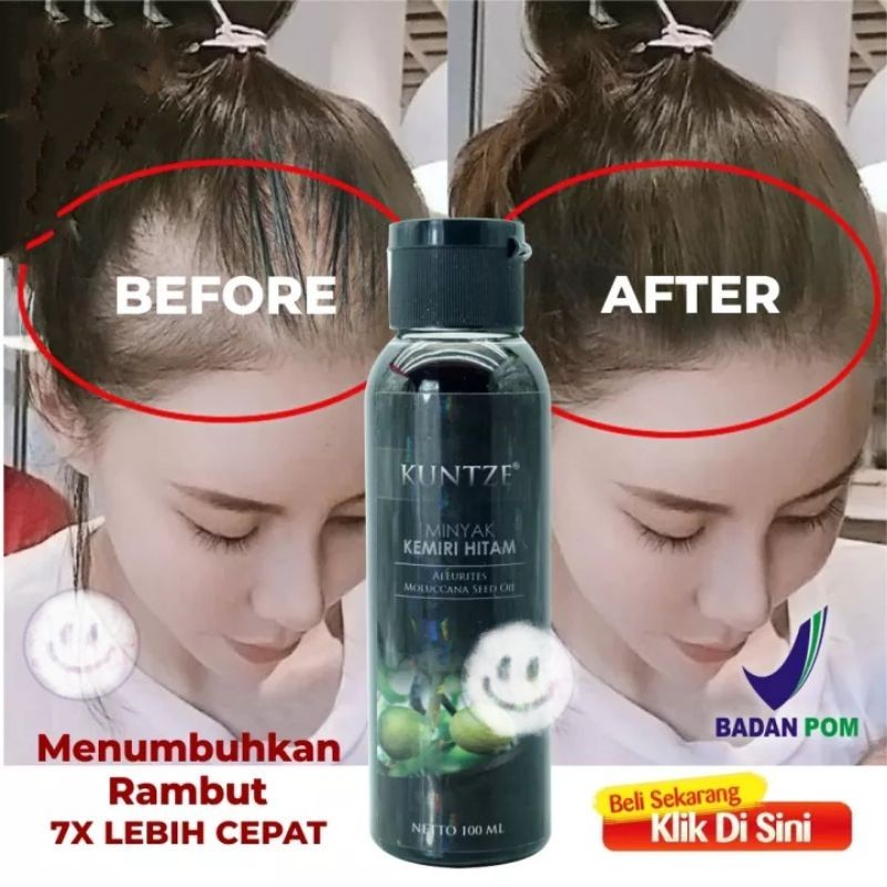 Jual Penumbuh Rambut Botak Penyubur Rambut Rontok Penghitam Rambut ...