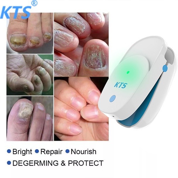 Jual KTS Mini Toenail Onychomycosis Therapy Cure Equipment Nail Fungus ...