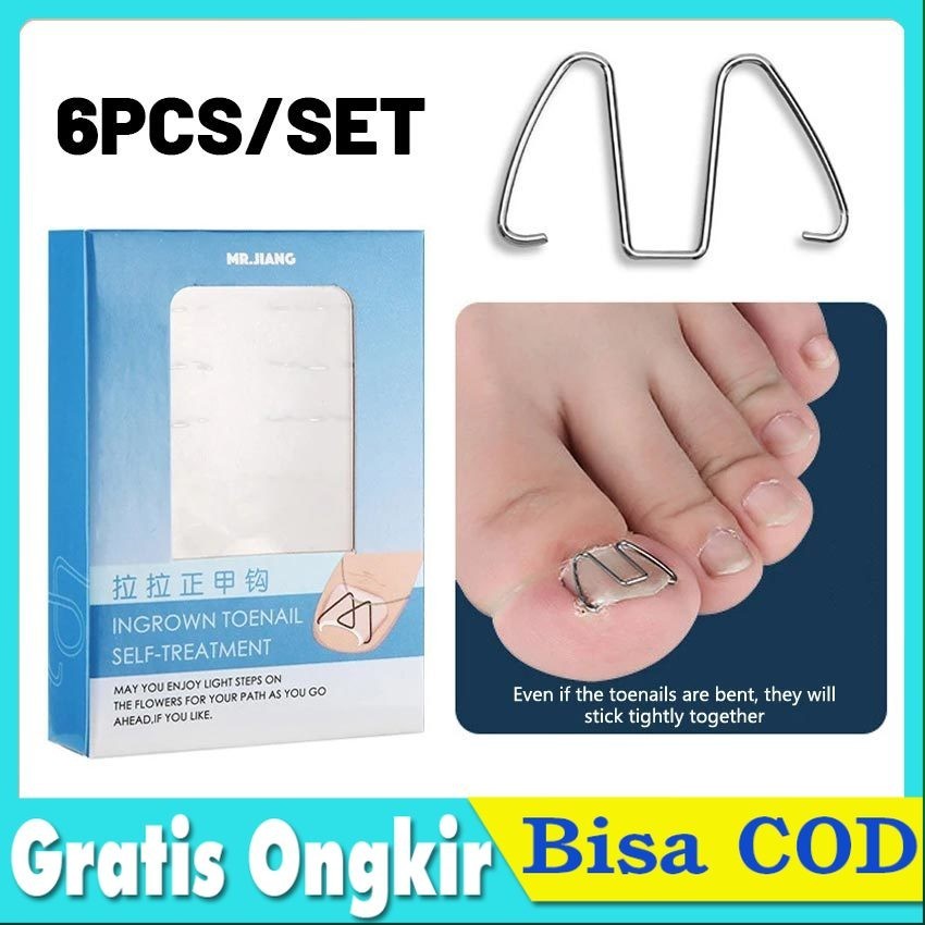 Jual 6pcs Alat Koreksi Kuku Orthotic Bunion Nail Corrector Pendorong ...