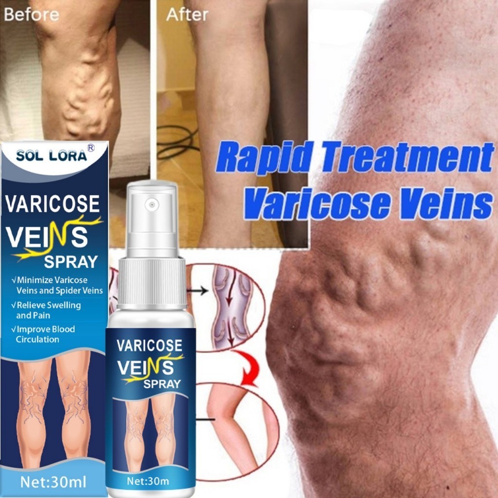 Jual SOL LORA Varicose vein spray 30ml Varises Cream Obat Varises Salep ...
