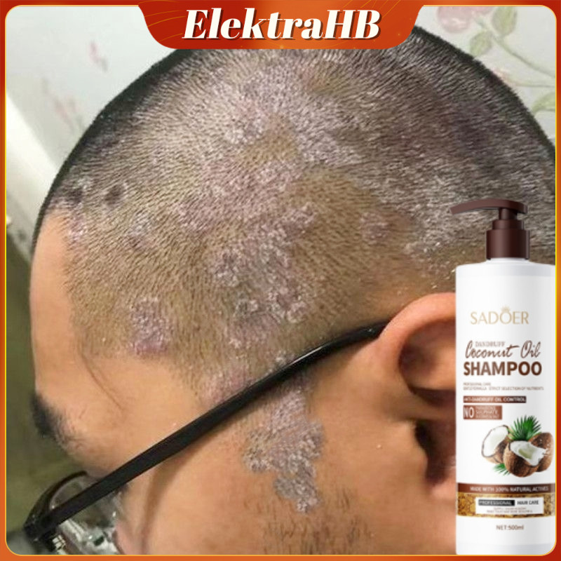 Jual Original Shampo anti ketombe Sampoo Ketombe Minyak Penghilang ketombe berkerak dan gatal ...