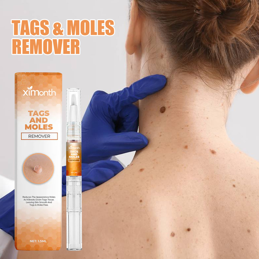Jual Ximonth Obat Kutil Pen Penghilang Tahi Lalat Skin Tag Remover ...