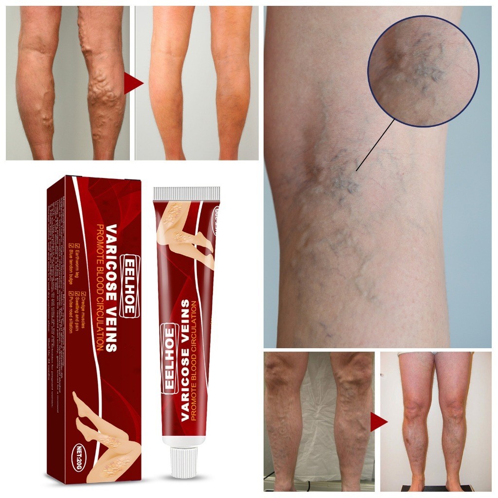Jual EELHOE Varicose Veins Cream 20g Varicose Vein Repair Cream Obat ...