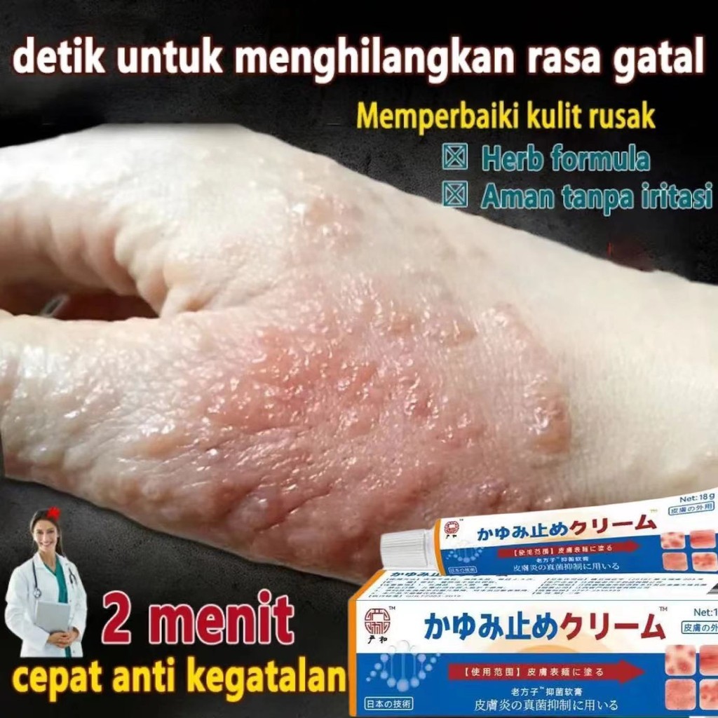 Jual 【100% Original】Salep Gatal Paling Ampuh Obat Psoriasis Salep Gatal ...
