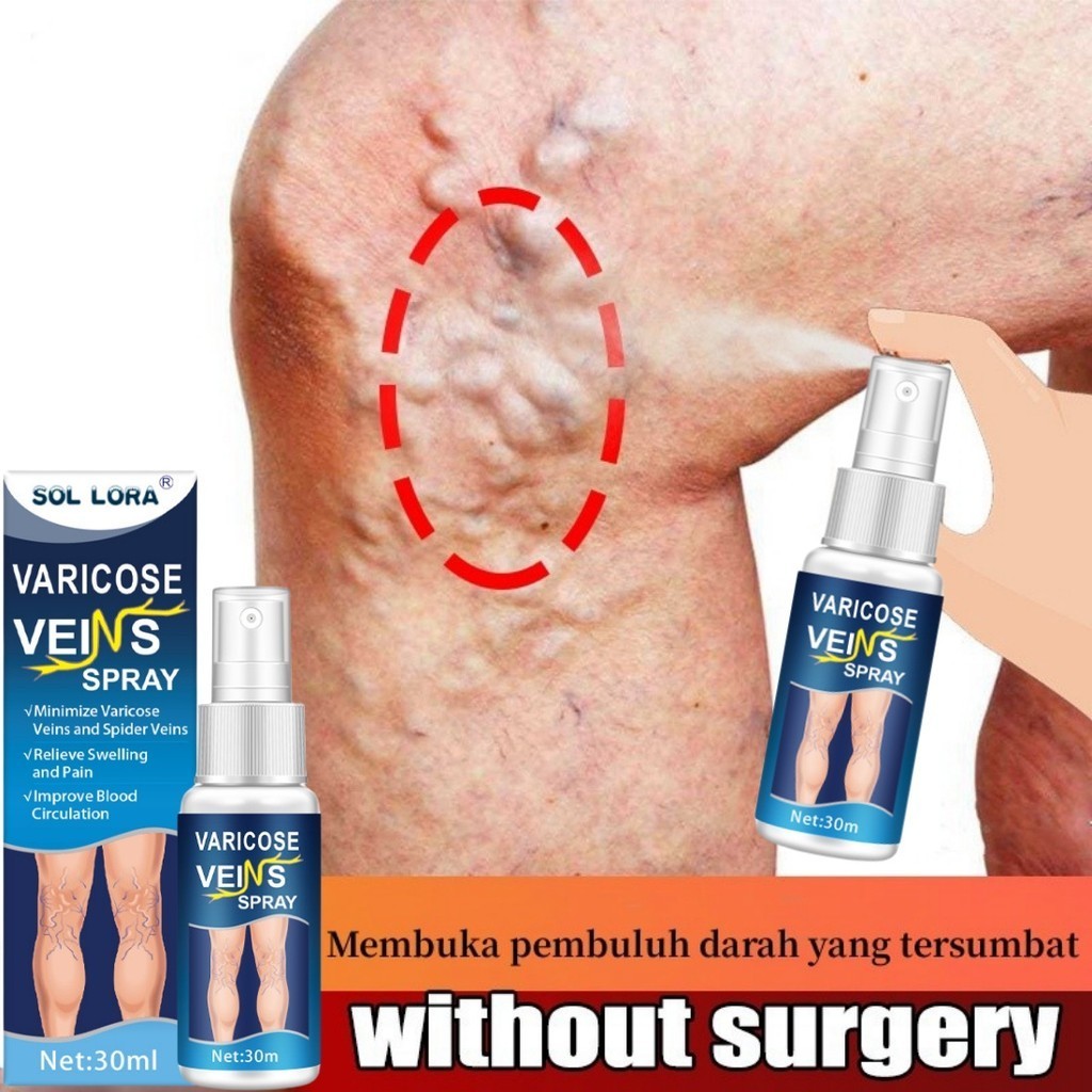 Jual SOLLORA Varicose Veins Spray Obat Varises Salep Penghilang Varises ...