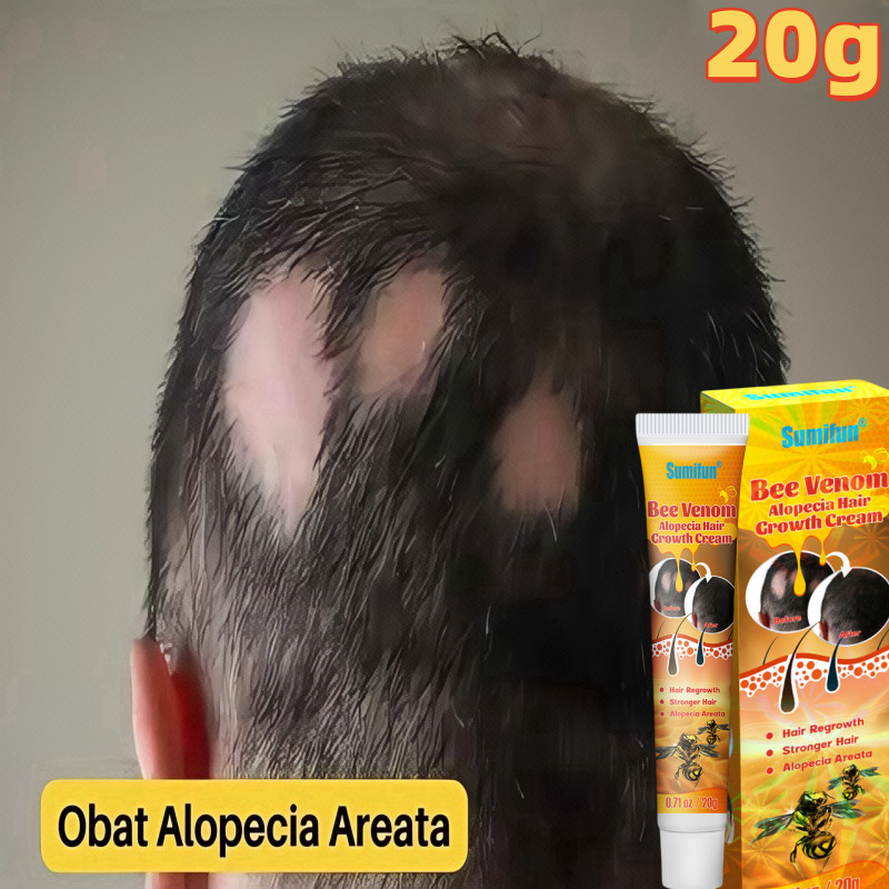 Jual Obat Alopecia Areata penumbuh rambut obat rambut rontok Obat ...