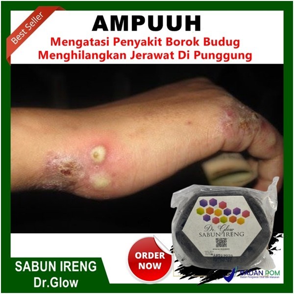 Jual Sabun bulus obat gatal kulit borok scabies bernanah budug gudik ...